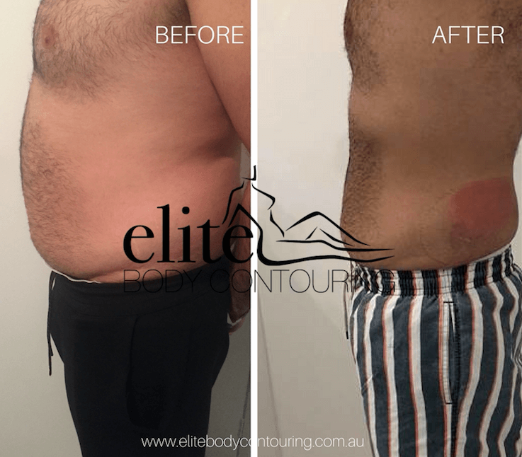 Client Results - Elite Body Contouring | Before and After Fat Freezing