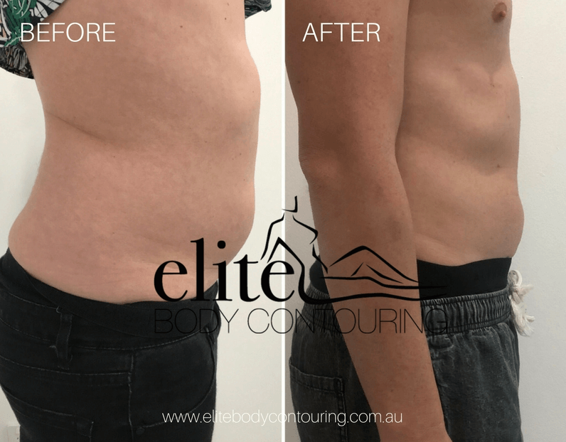 Client Results - Elite Body Contouring | Before and After Fat Freezing